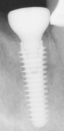 Megagen Anyridge Implante dental | SpotImplant