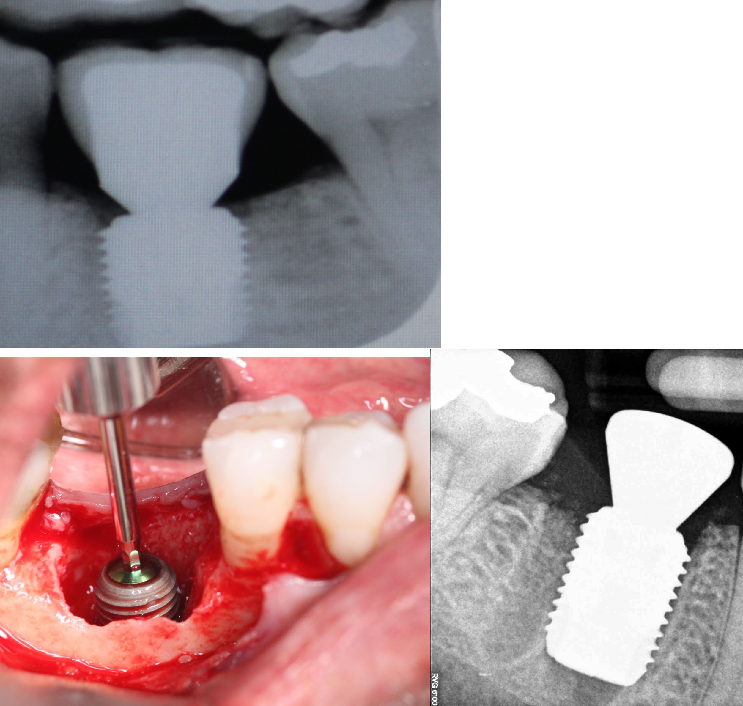 Megagen Rescue Internal Dental Implant | SpotImplant