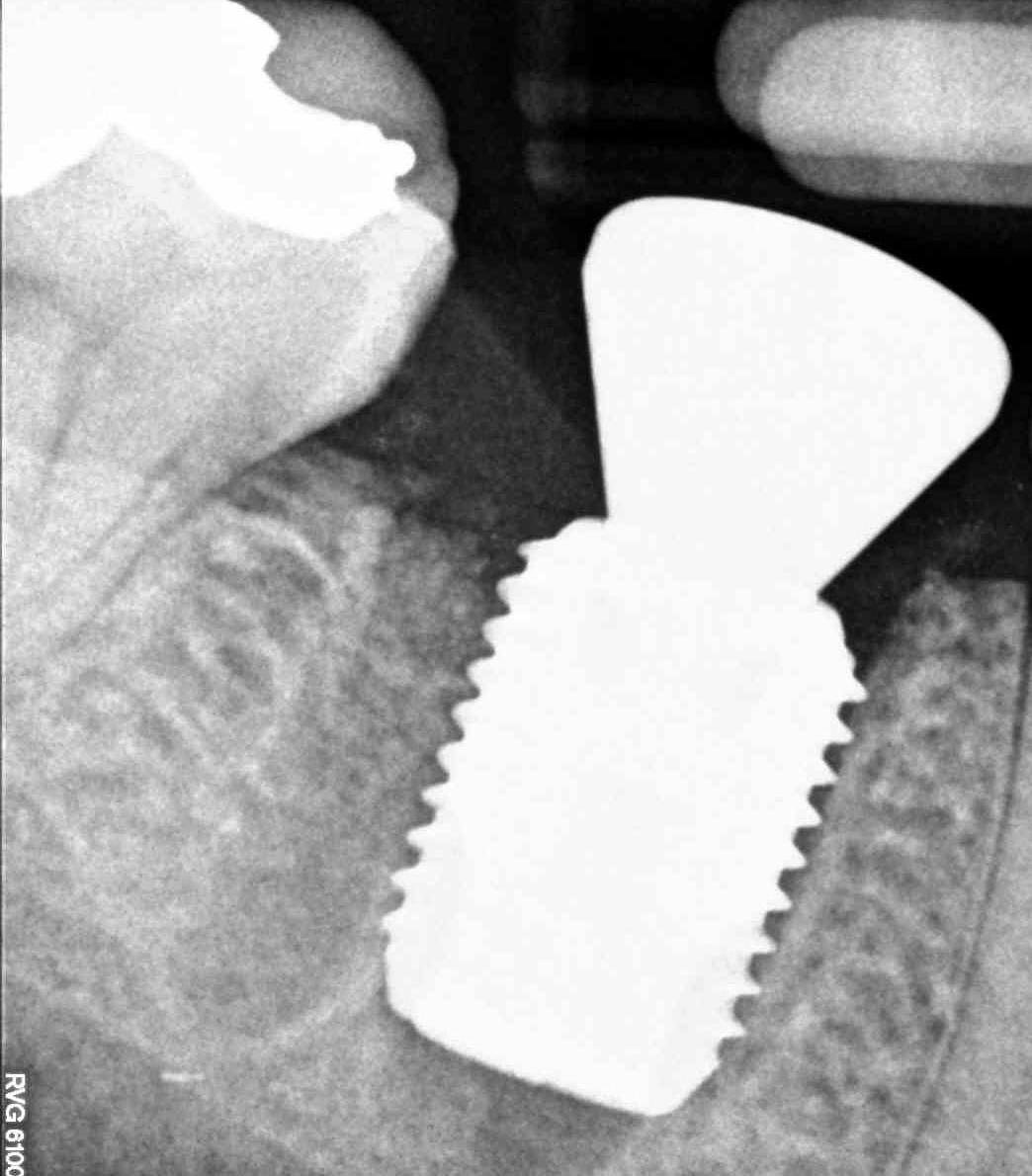 Megagen Rescue Internal Dental Implant | SpotImplant