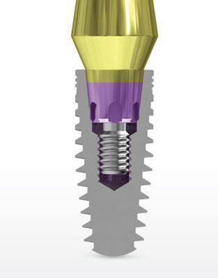 MIS C1 Implante dental | SpotImplant