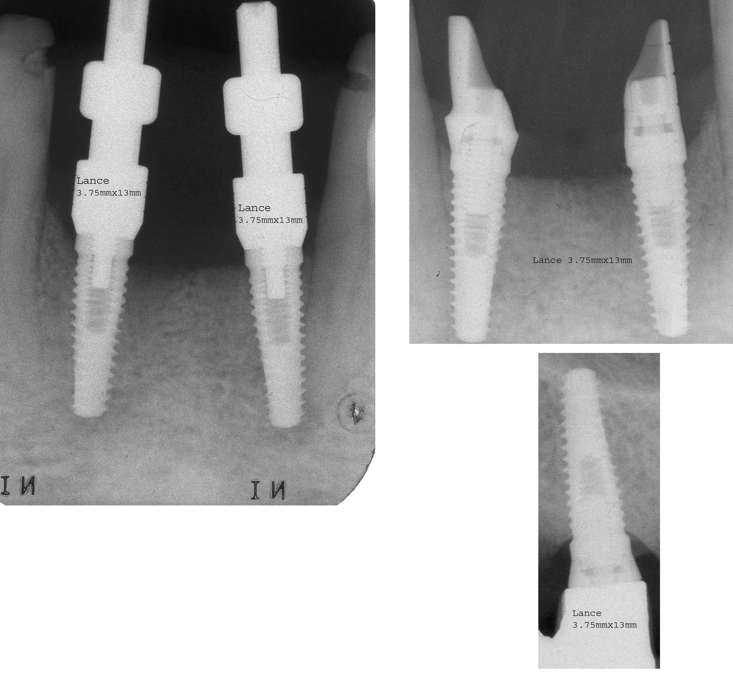 MIS Lance External hexagon Implant dentaire | SpotImplant
