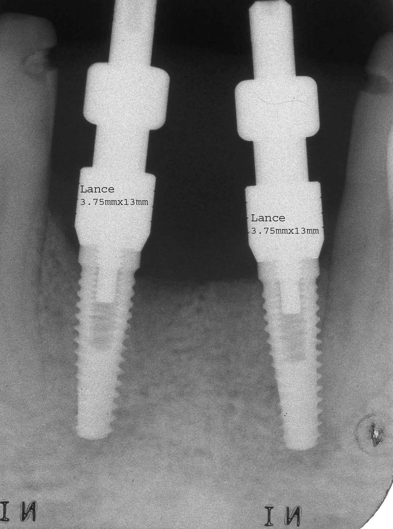 MIS Lance External hexagon Implant dentaire | SpotImplant
