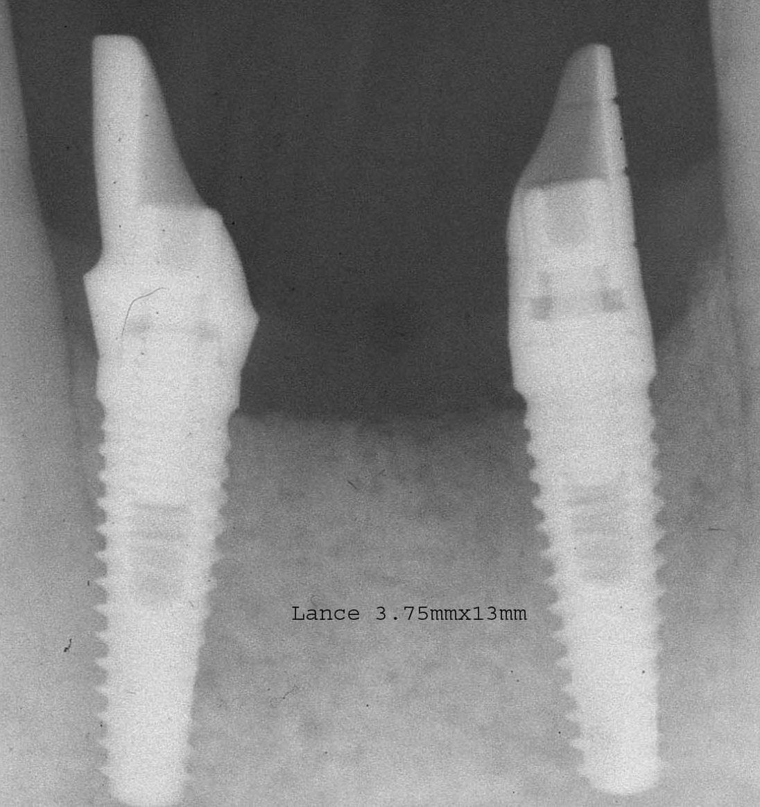 MIS Lance External hexagon Implant dentaire | SpotImplant