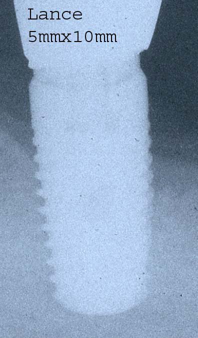 MIS Lance Plus Implante dental | SpotImplant