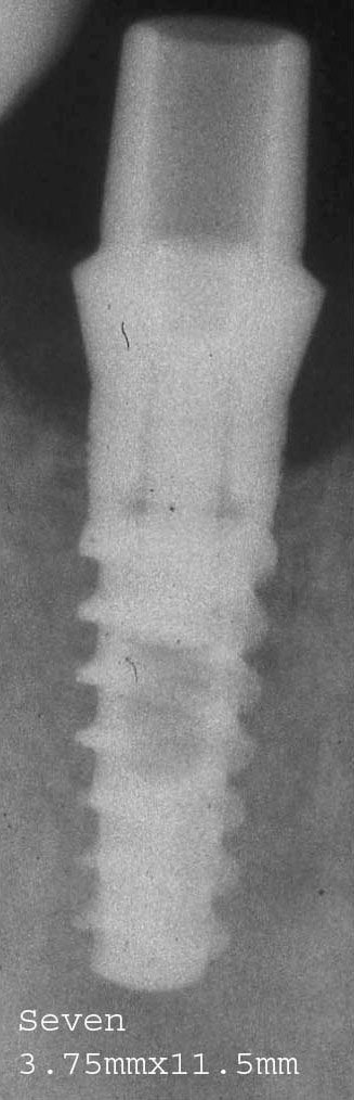MIS Seven Implante dental | SpotImplant