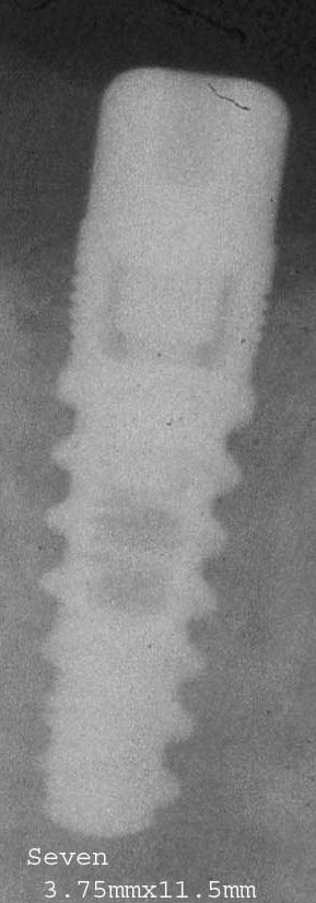 MIS Seven Implante dental | SpotImplant