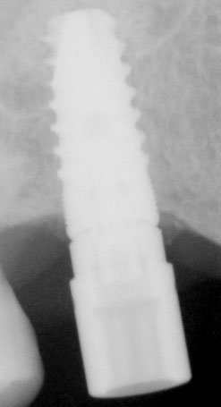 MIS Seven Implante dental | SpotImplant