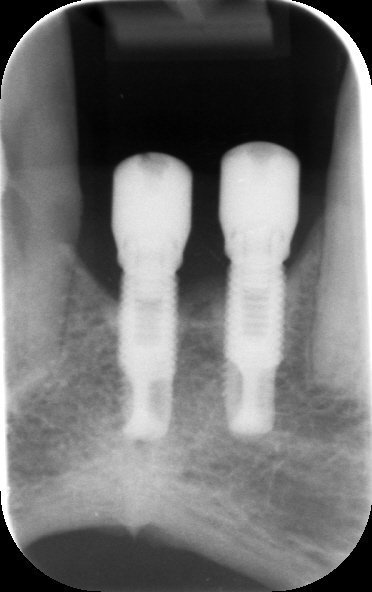 Nobel Biocare Branemark System MK II (Regular) Implant dentaire ...
