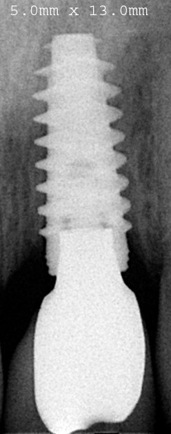 Nobel Biocare NobelActive Implante dental | SpotImplant