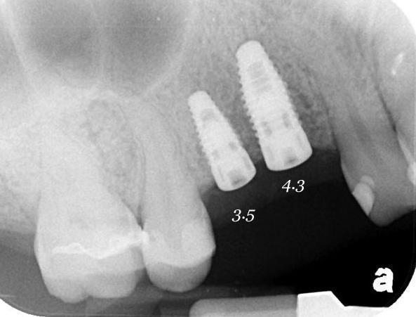 Nobel Biocare NobelReplace Tapered Implante dental | SpotImplant