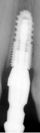 Osstem Implant Company GS III Dental Implant | SpotImplant