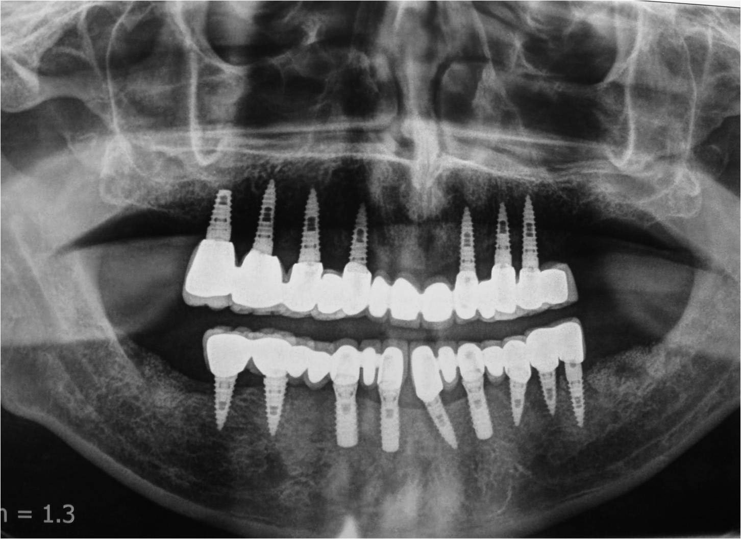 OsteoCare Maxi Z Dental Implant | SpotImplant