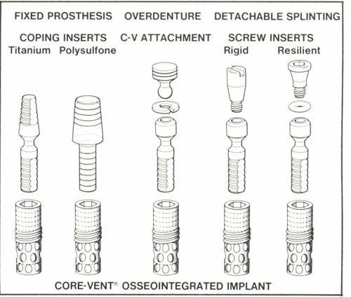 Paragon Core-Vent Implant dentaire | SpotImplant