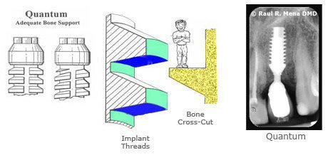 Quantum BioEngineering QVS Thread Dental Implant | SpotImplant
