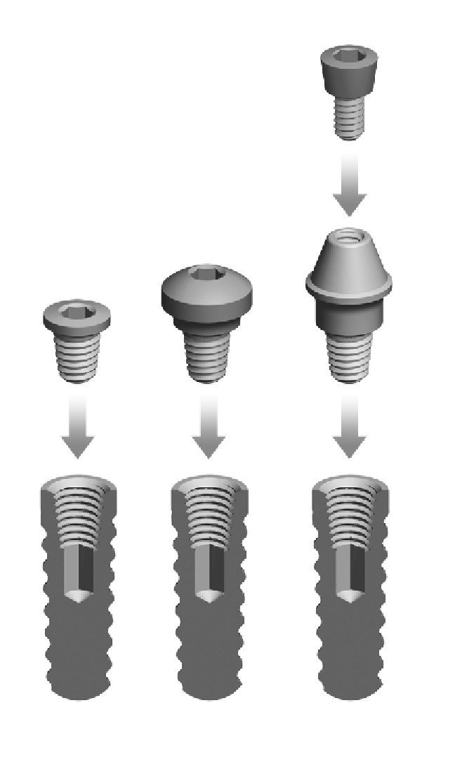 Radix (Proekcia Ltd.) Gimlet-IIS Dental Implant | SpotImplant