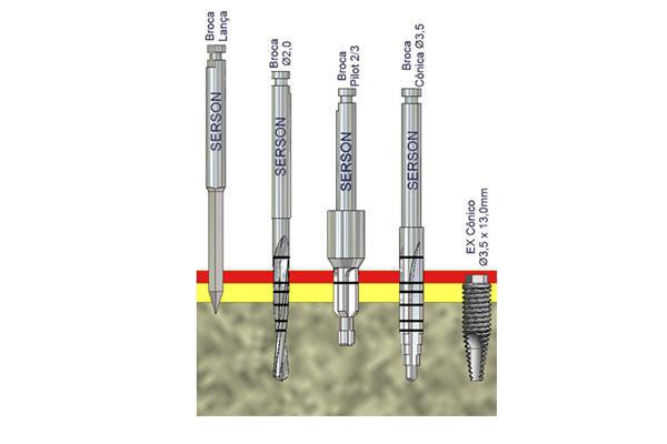 Serson Implant Ex Conico Dental Implant | SpotImplant