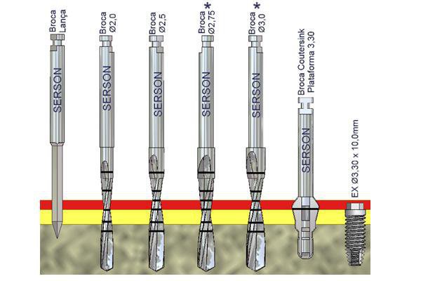 Serson Implant Ex (Sext Ext) Dental Implant | SpotImplant