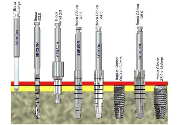 Serson Implant Implus Conico Implante dentário | SpotImplant