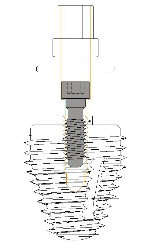 Southern Implants External Hex Max Implant dentaire | SpotImplant