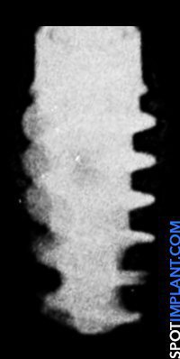 Straumann BLX Regular Base Implante dental | SpotImplant