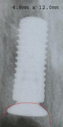 Straumann Bone Level Implante dental | SpotImplant