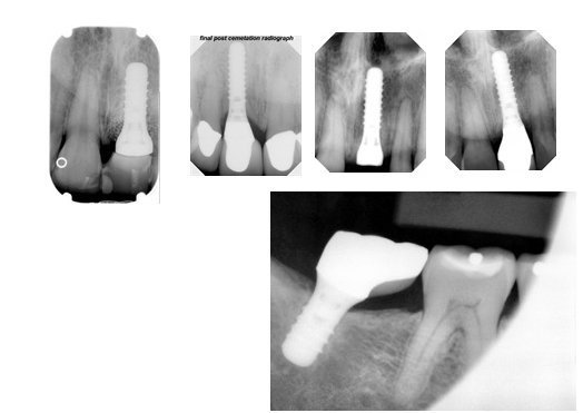 Straumann Standard Implant dentaire | SpotImplant