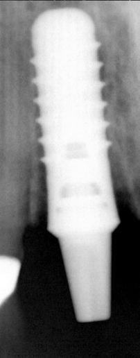 Straumann Standard (Straight Head) Dental Implant | SpotImplant