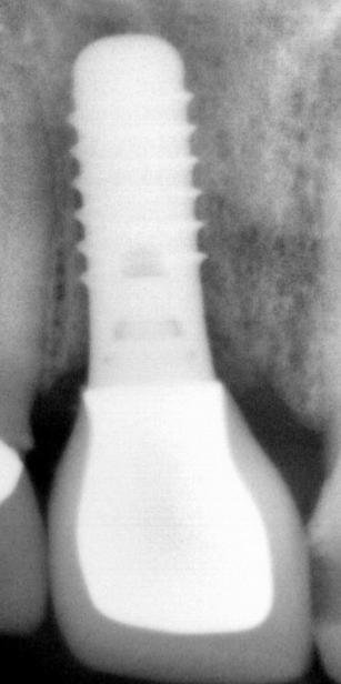 Straumann Standard (Straight Head) Dental Implant | SpotImplant