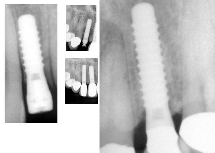 Straumann Standard Plus Implante dentário | SpotImplant