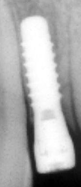 Straumann Standard Plus Implant dentaire | SpotImplant