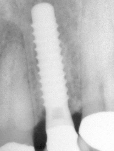 Straumann Standard Plus Implante dental | SpotImplant