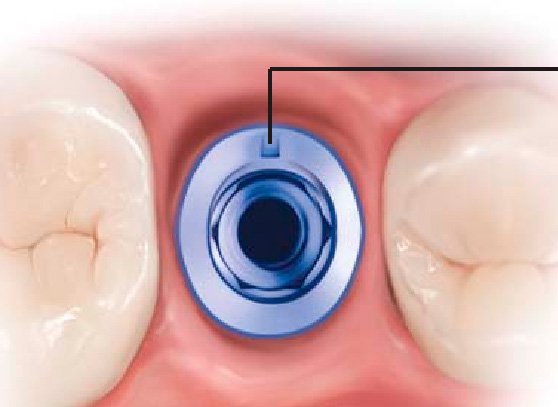 Sybron [Innova] Anatomic Dental Implant | SpotImplant