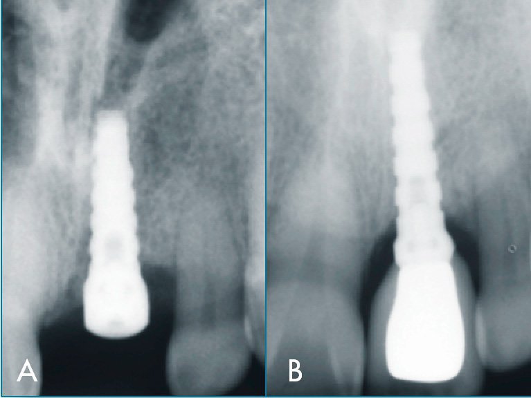Sybron [Innova] Anatomic Dental Implant | SpotImplant