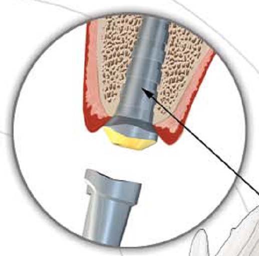 Sybron [Innova] Anatomic Implante dental | SpotImplant