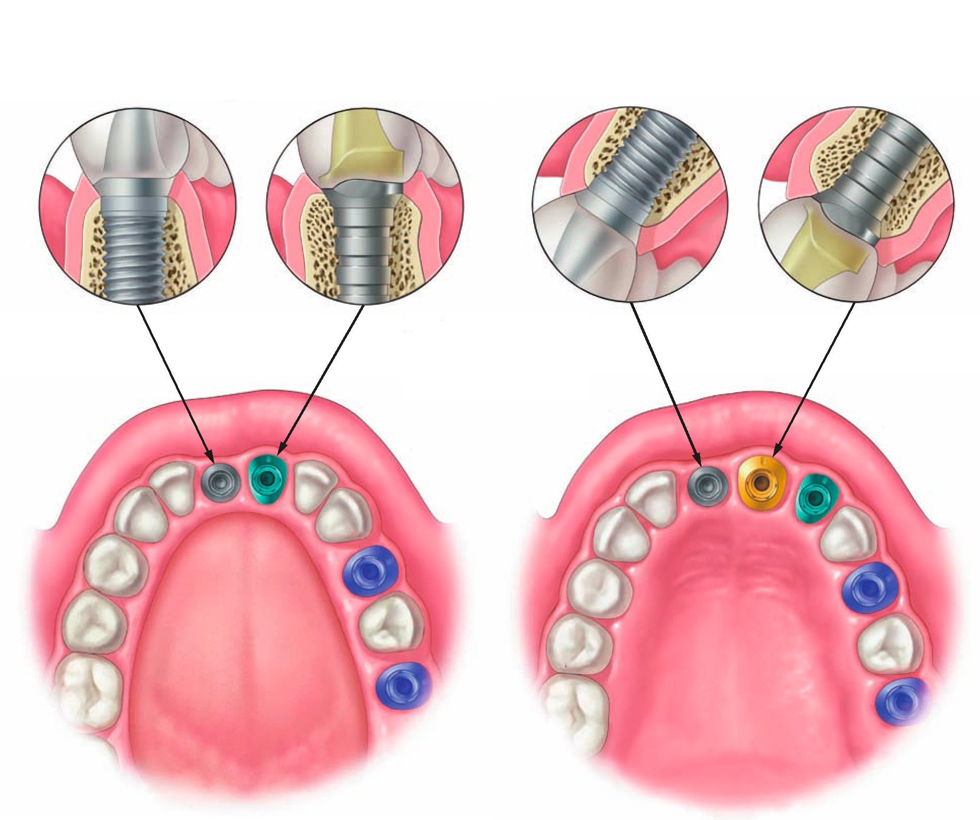 Sybron [Innova] Anatomic Dental Implant | SpotImplant
