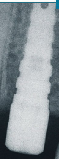 Sybron [Innova] Anatomic Dental Implant | SpotImplant