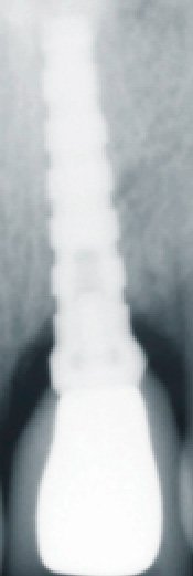 Sybron [Innova] Anatomic Dental Implant | SpotImplant