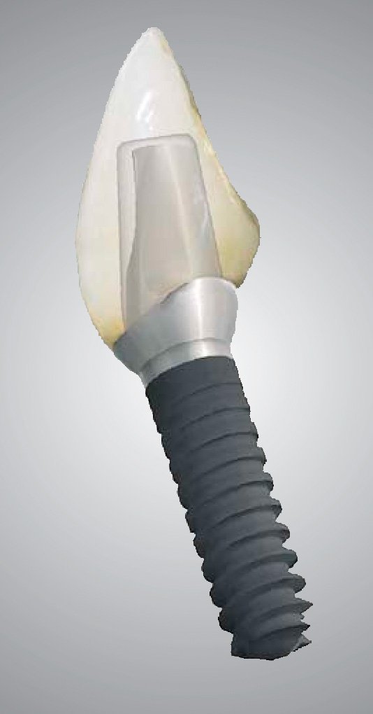 Sybron [Innova] Pitt Easy Zahnimplantat | SpotImplant