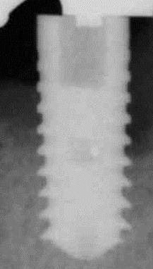 Sybron [Innova] Pitt Easy Implante dental | SpotImplant