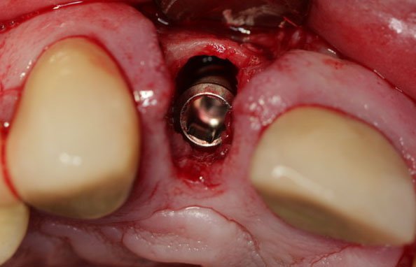 Sybron [Innova] SybronPro XRT Implante dental | SpotImplant