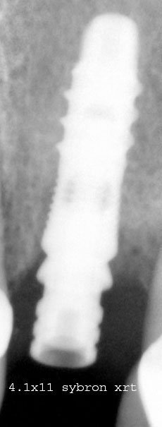 Sybron [Innova] SybronPro XRT Implant dentaire | SpotImplant