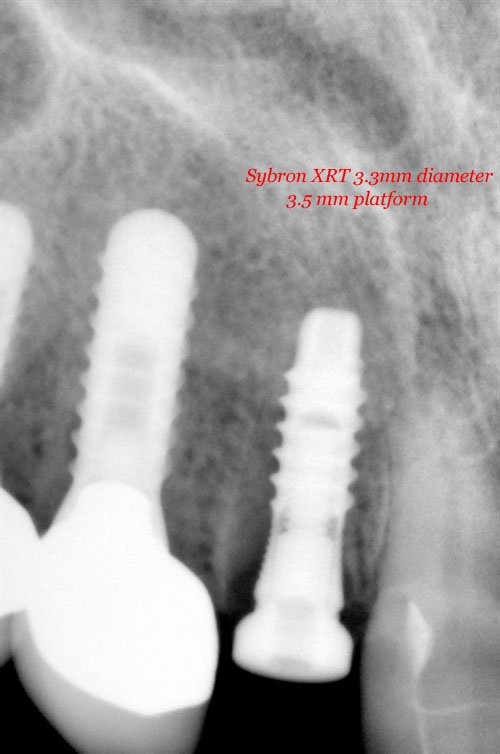 Sybron [Innova] SybronPro XRT Implant dentaire | SpotImplant