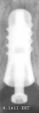 Sybron [Innova] SybronPro XRT Implante dental | SpotImplant