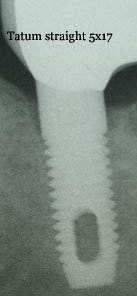 Tatum Surgical Screw Root Form Dental Implant | SpotImplant