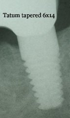 Tatum Surgical Tapered Root Form Impianto dentale | SpotImplant