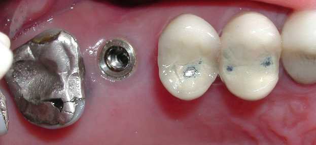 Thommen SPI Contact (Flared Head) Dental Implant | SpotImplant