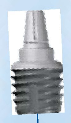 Trinon Titanium GIP Dental Implant | SpotImplant
