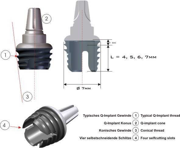 Trinon Titanium GIP Dental Implant | SpotImplant