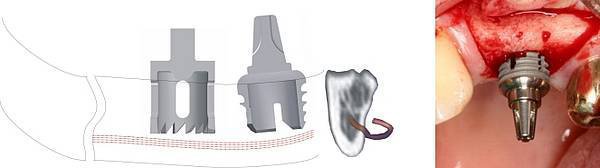 Trinon Titanium GIP Dental Implant | SpotImplant