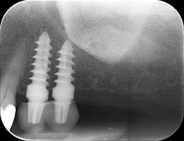 Trinon Titanium Q Implant dentaire | SpotImplant